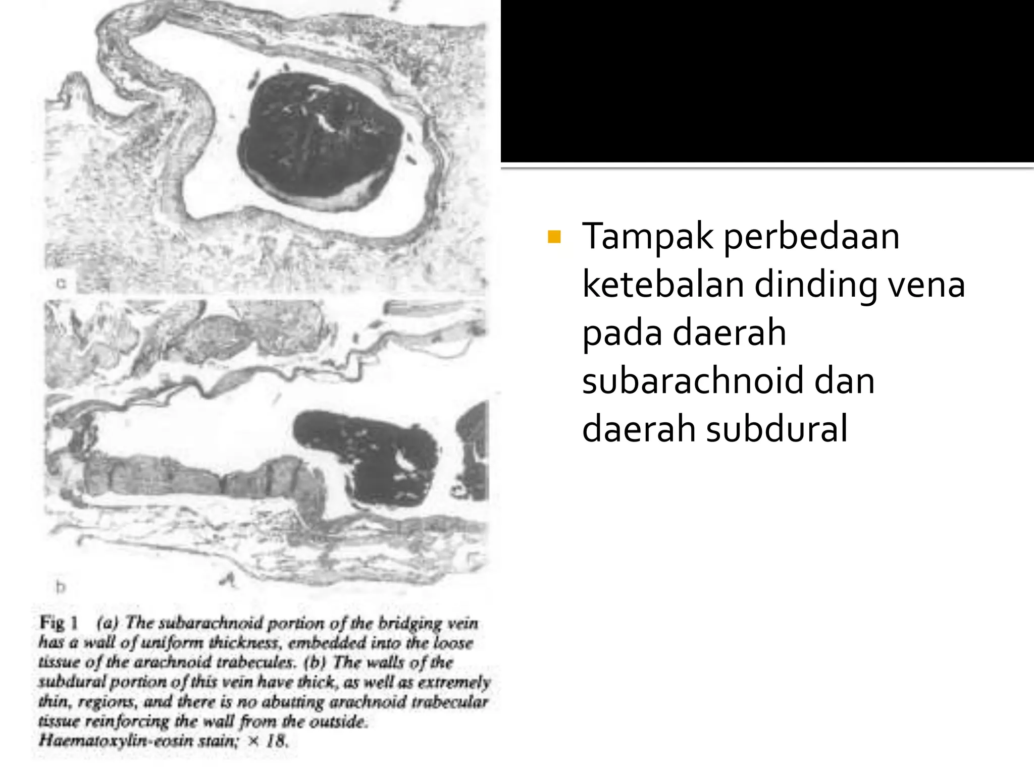 Why do bridging veins rupture into the virtual subdural space | PPTX