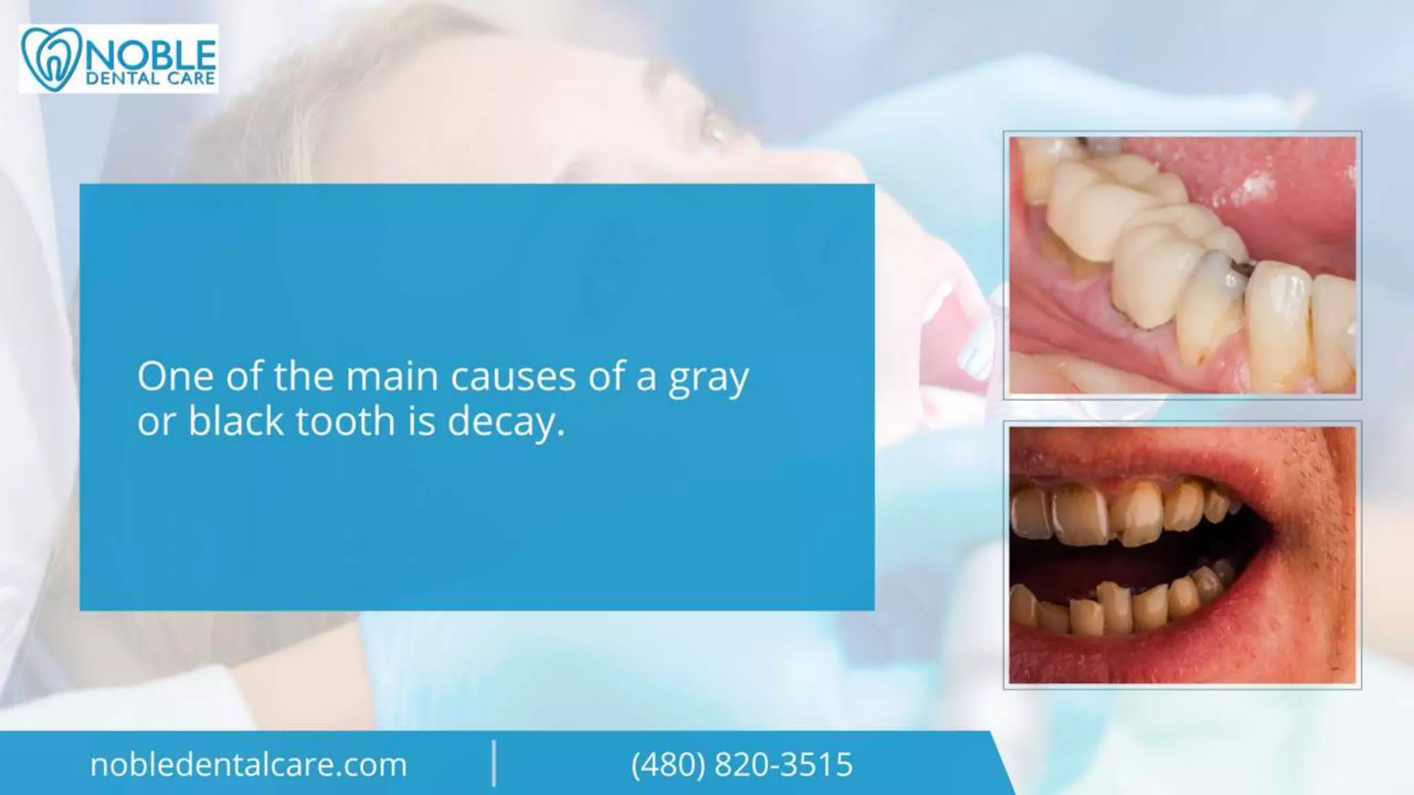 Why is My Tooth Turning Black.pptx