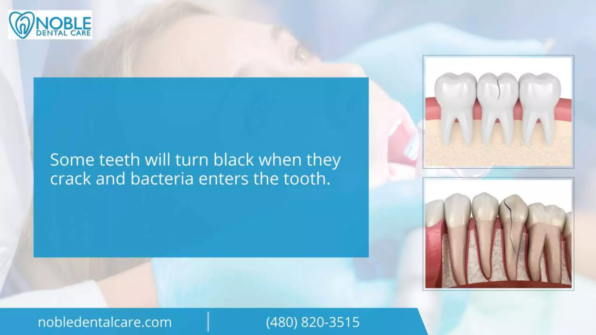 Why is My Tooth Turning Black.pptx