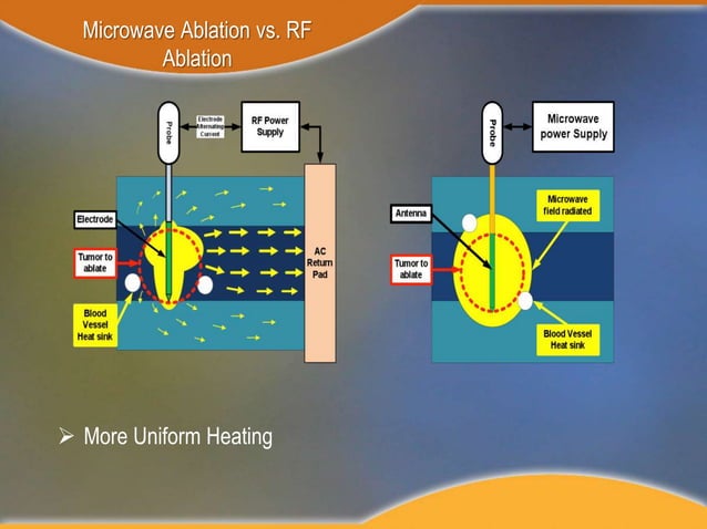 The Benefits of Microwave Ablation | PPTX | Chemistry | Science