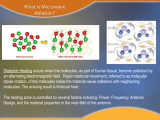 The Benefits of Microwave Ablation | PPTX
