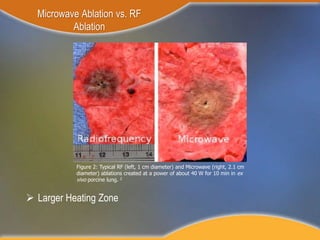 The Benefits of Microwave Ablation | PPTX