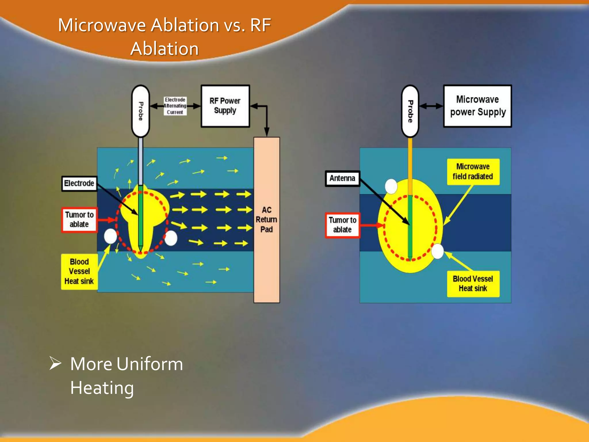 The benefits of microwave ablation | PPTX