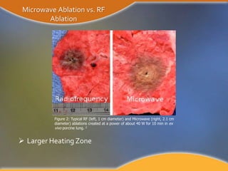 The benefits of microwave ablation | PPT