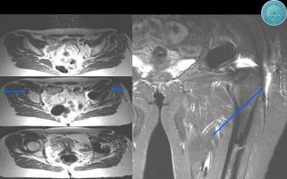 Why the Direct Anterior Approach for THA | PPT