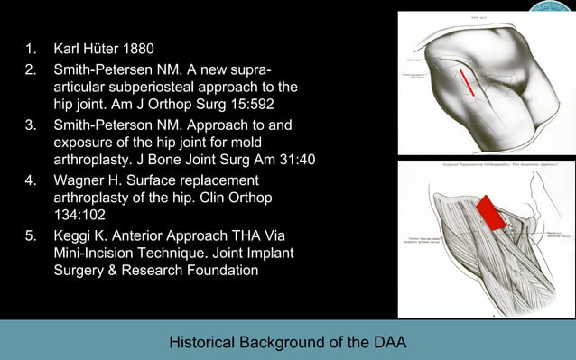 Why the Direct Anterior Approach for THA | PPT