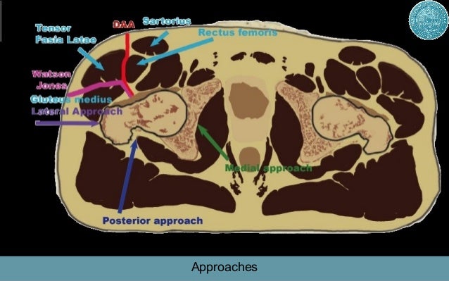 Why the Direct Anterior Approach for THA