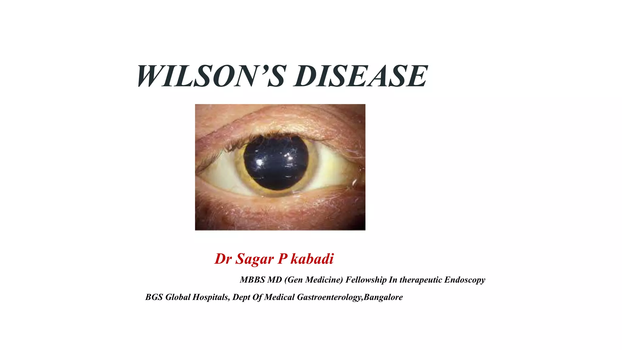 Wilson's Disease Dr Sagar | PPT