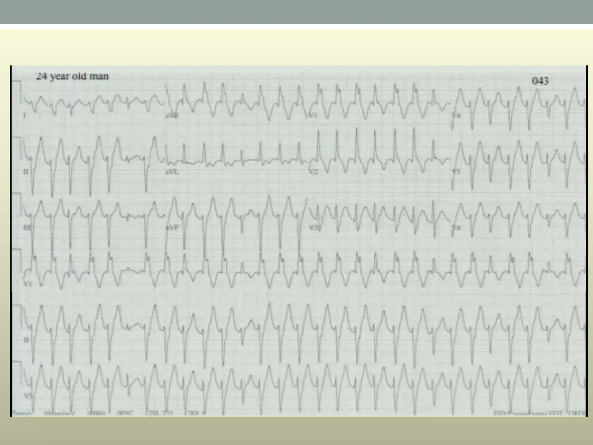 Wide complex tachycardia | PPT