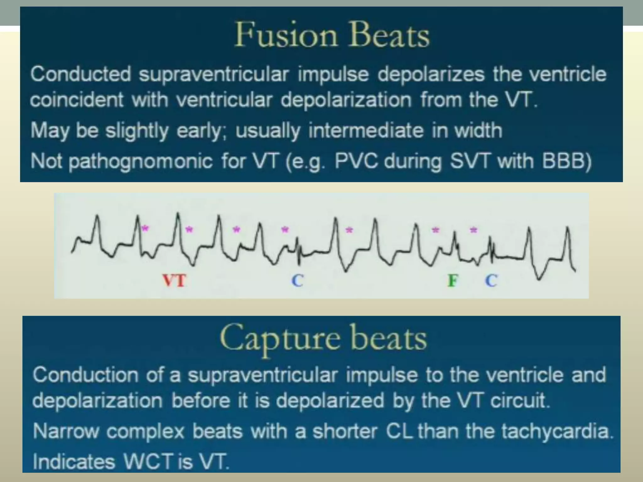 Wide complex tachycardia | PPT