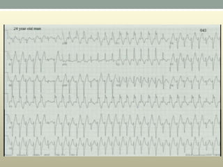 Wide complex tachycardia | PPT