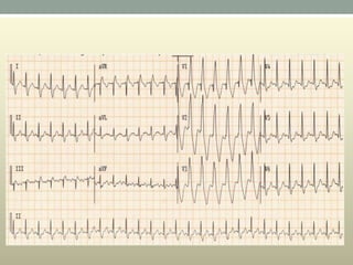 Wide complex tachycardia | PPT