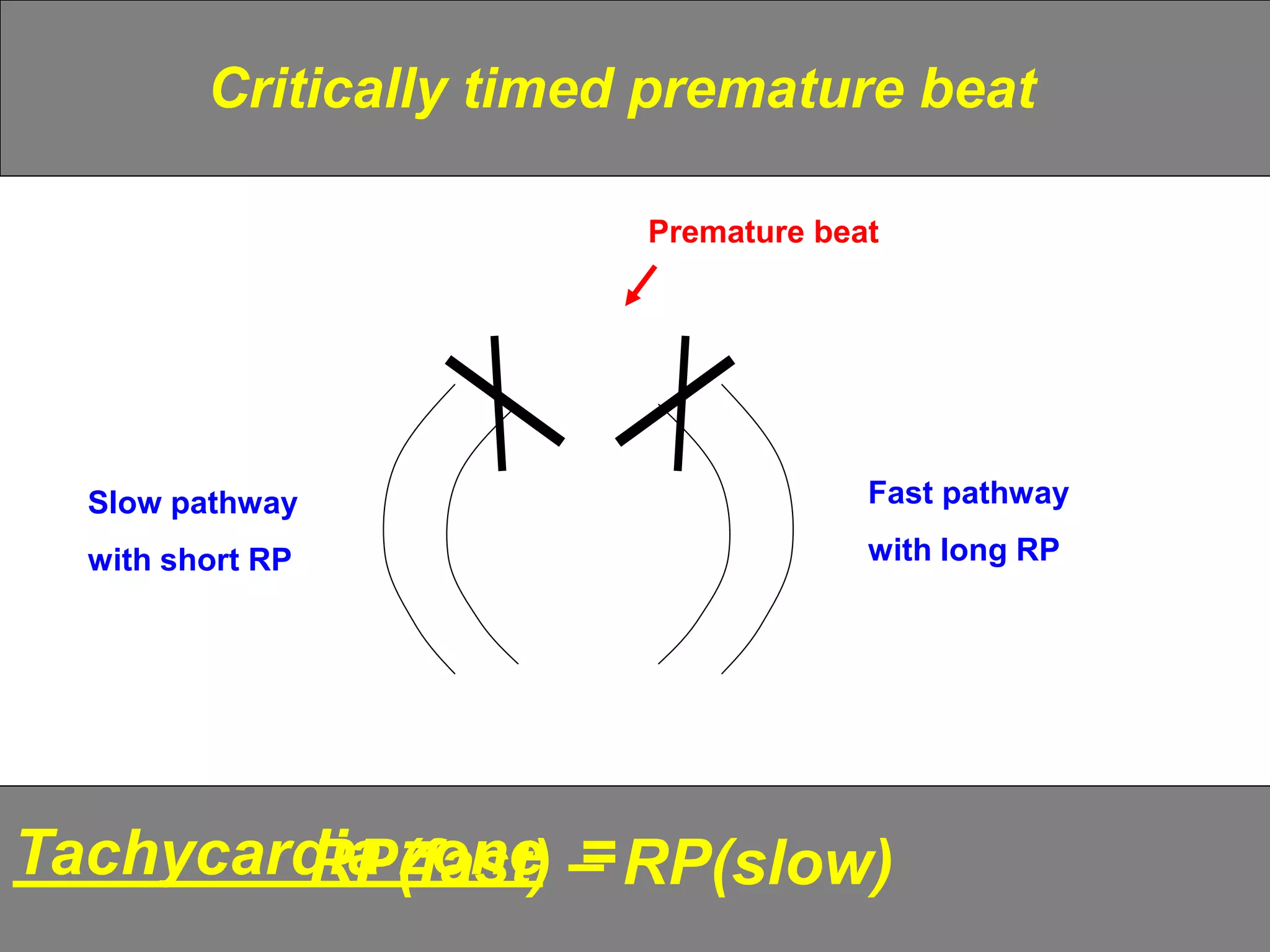 Wide complex tachycardia | PPTX
