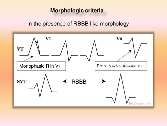 Wide complex tachycardia