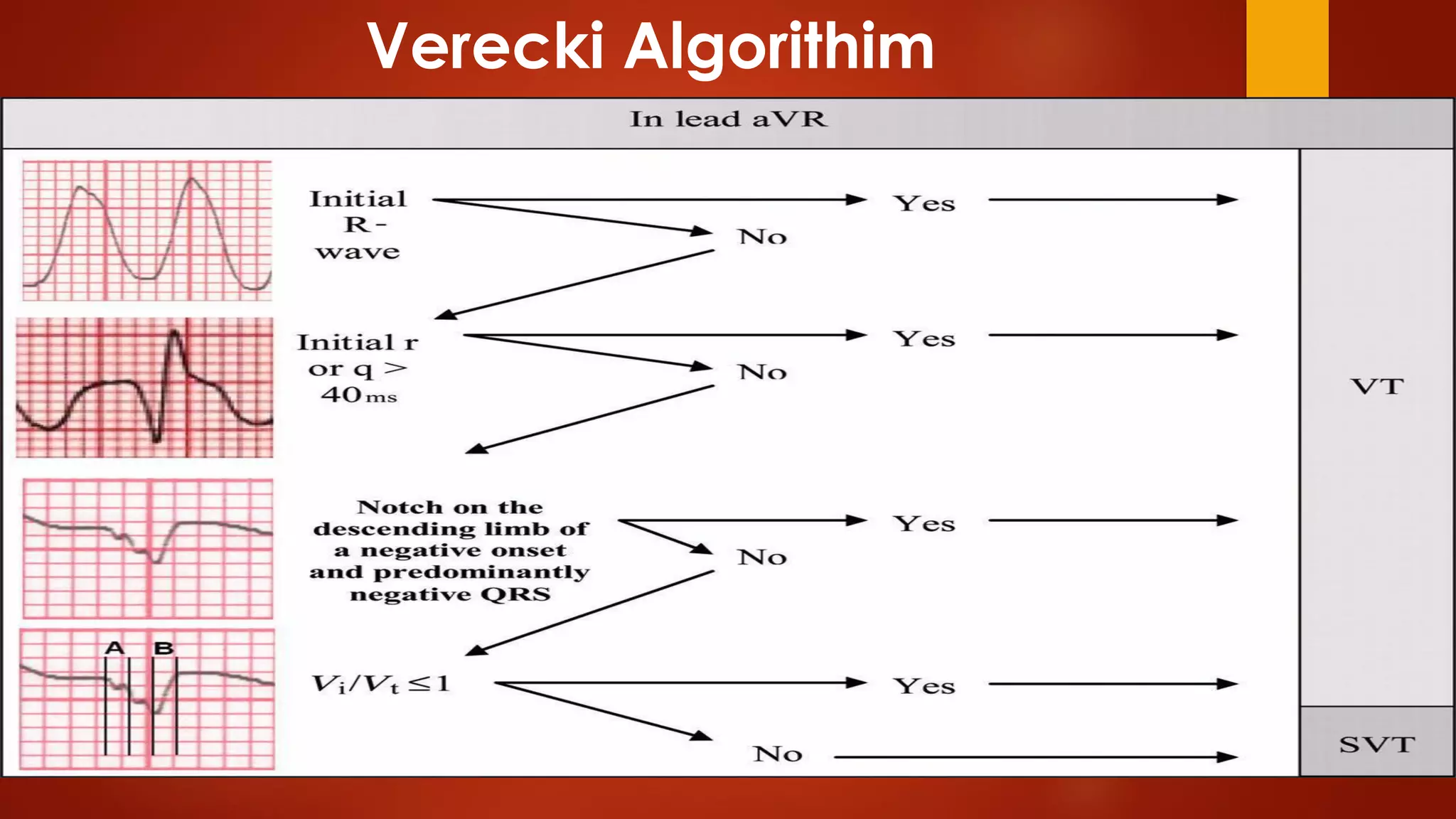Wide Complex Tachycardia | PDF