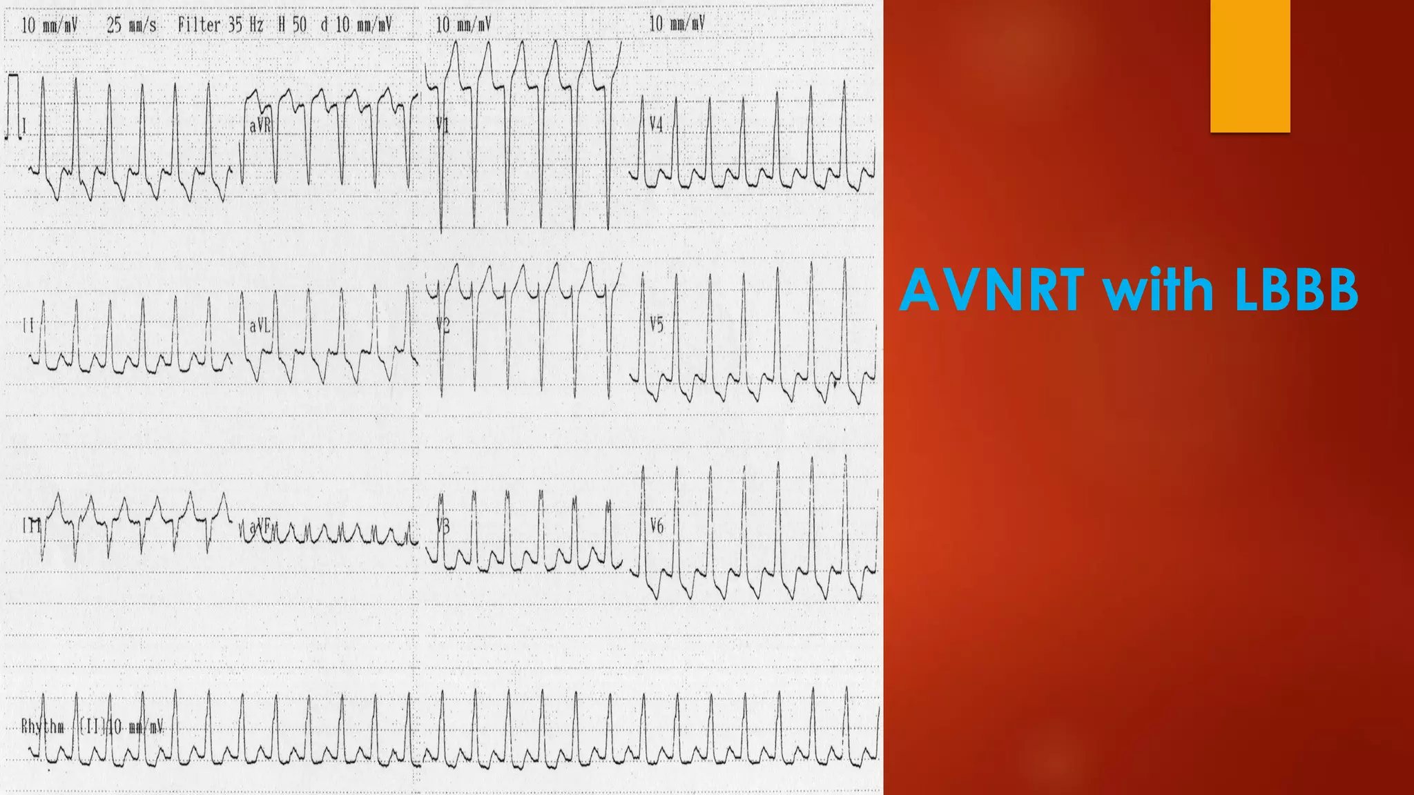 Wide Complex Tachycardia | PDF