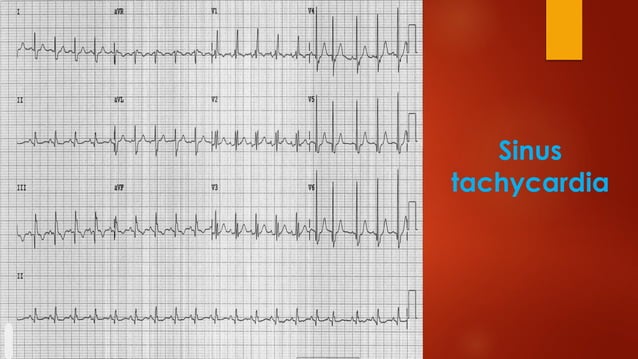 Wide Complex Tachycardia | PPT