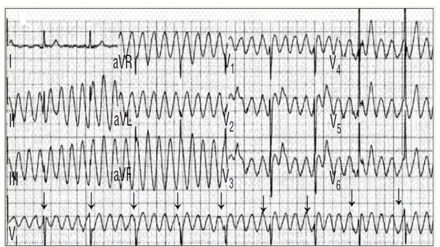 Wide Complex Tachycardia | PPT