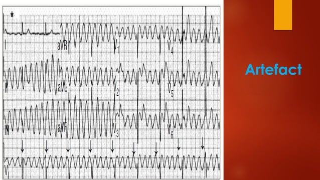 Wide Complex Tachycardia | PPT