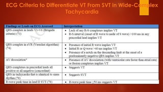 Wide Complex Tachycardia | PPT