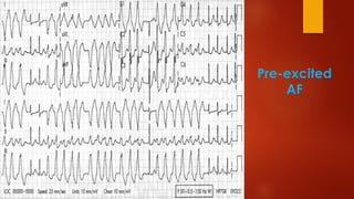 Wide Complex Tachycardia | PPT