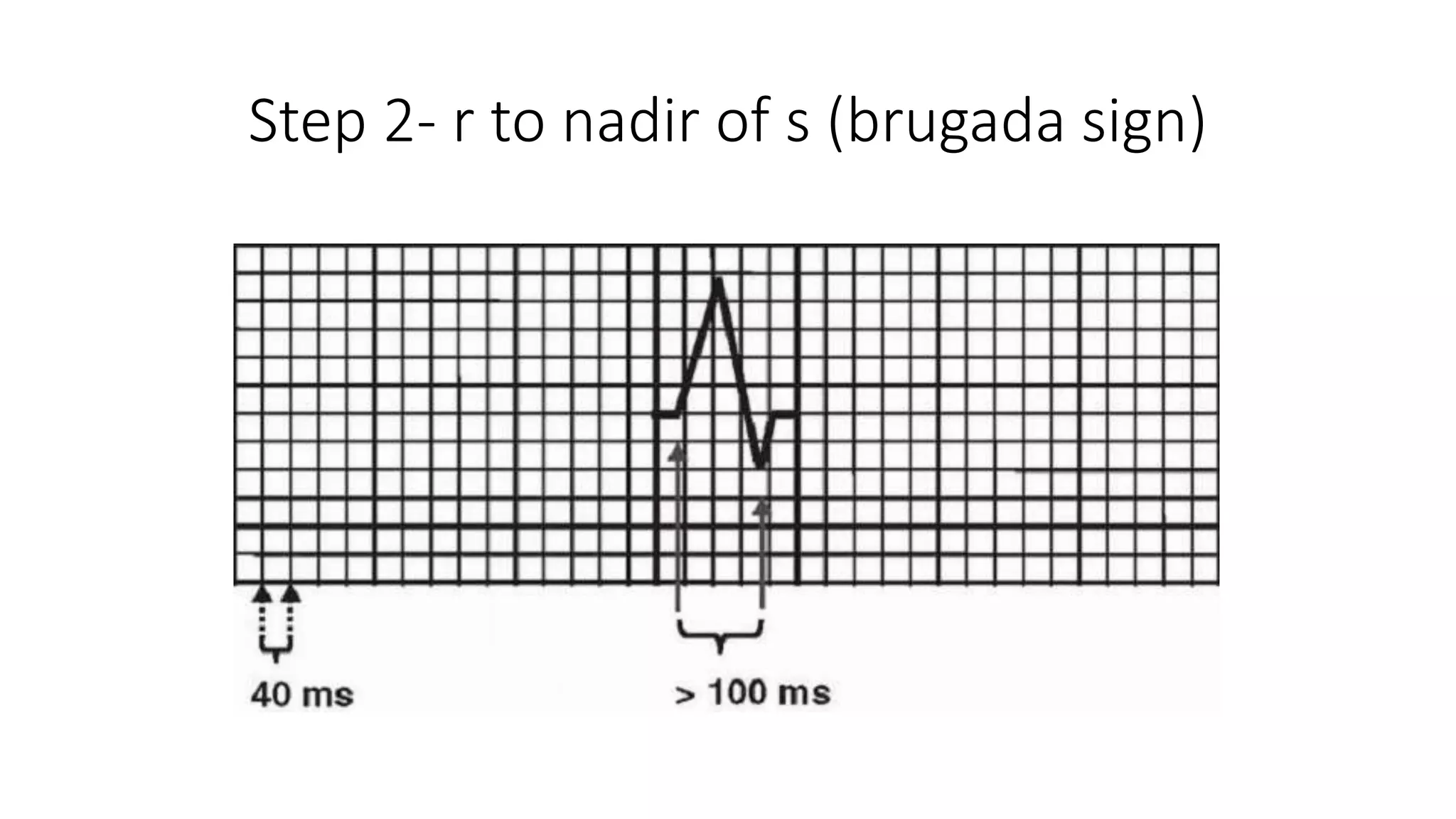 Wide complex tachycardia | PPTX