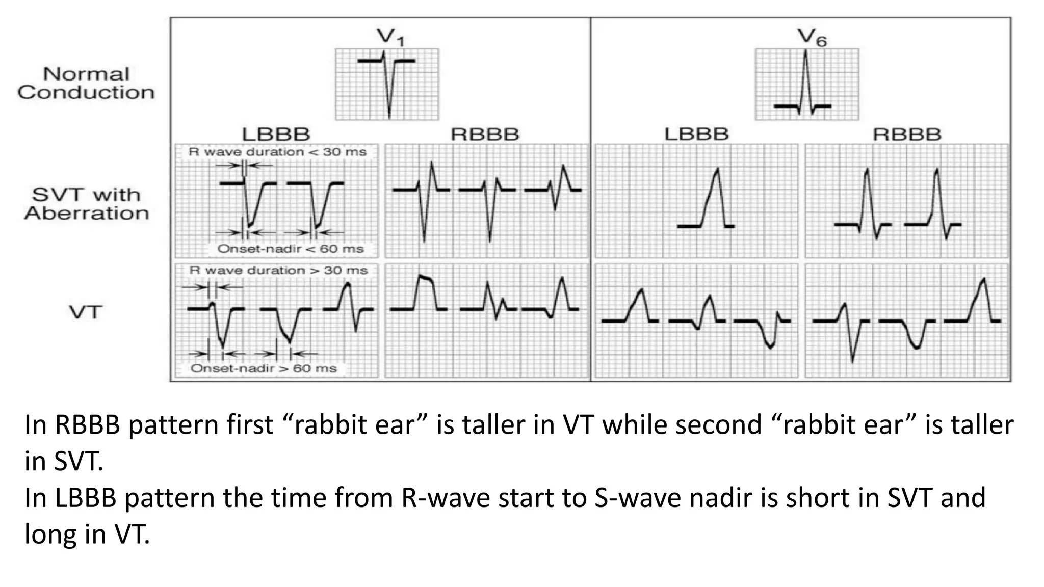 Wide complex tachycardia | PPTX