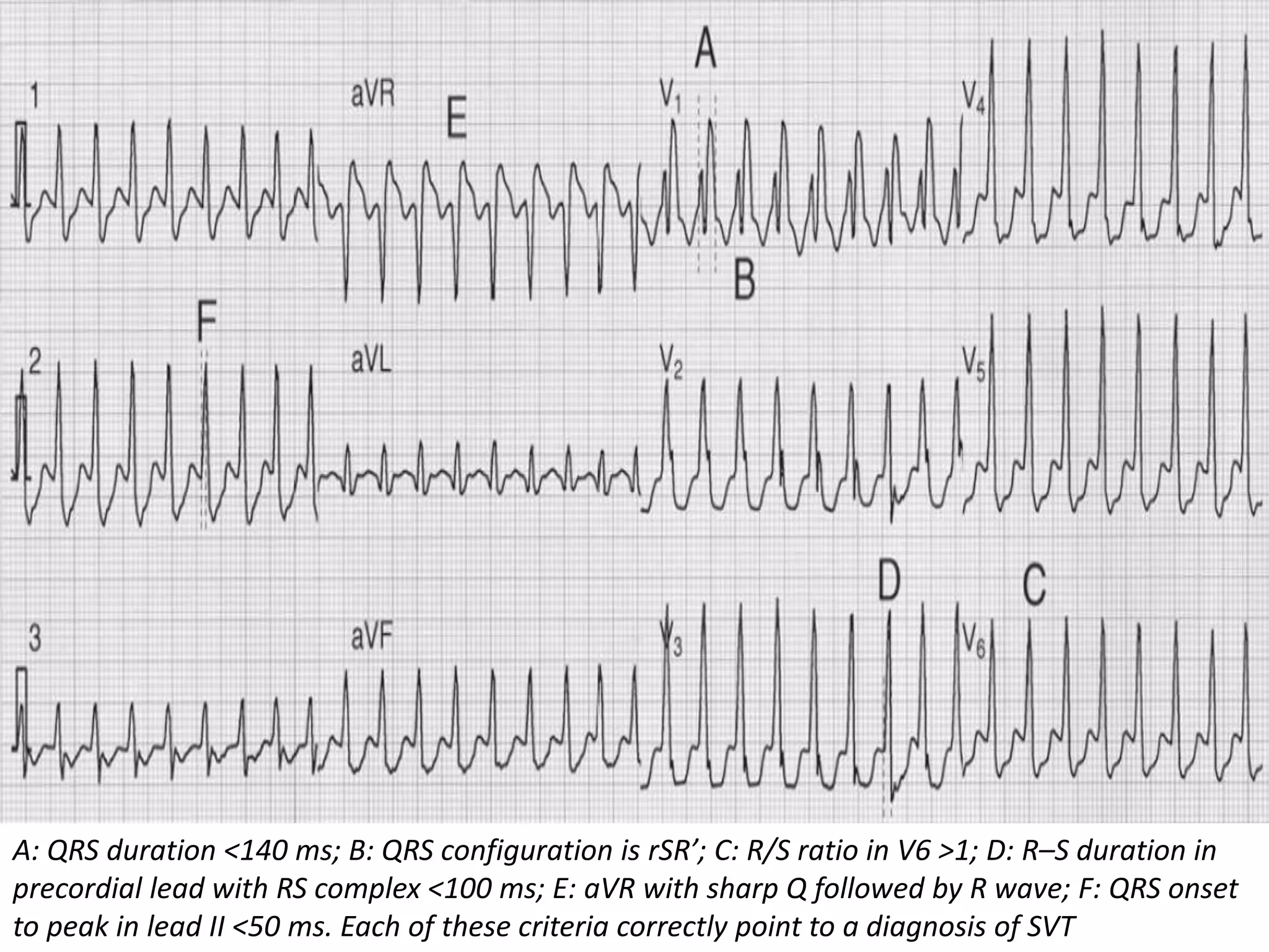 Approach to Wide complex tachycardia /cardiology | PPTX