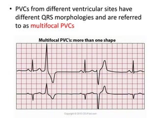 Approach to Wide complex tachycardia /cardiology | PPTX