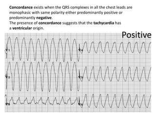 Approach to Wide complex tachycardia /cardiology | PPTX