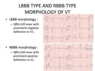 Approach to Wide complex tachycardia /cardiology | PPTX