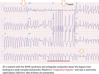 Approach to Wide complex tachycardia /cardiology | PPTX