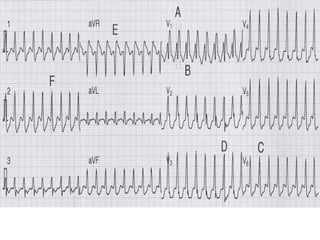 Approach to Wide complex tachycardia /cardiology | PPT