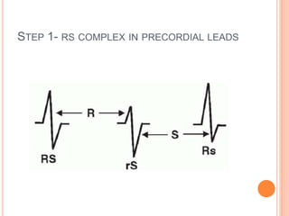 Wide complex tachycardia drneeraj | PPT