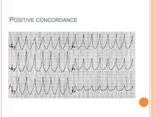 Wide complex tachycardia drneeraj | PPT