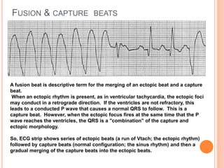 Wide complex tachycardia drneeraj | PPT