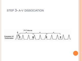 Wide complex tachycardia drneeraj | PPT