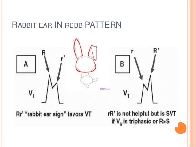 Wide complex tachycardia drneeraj