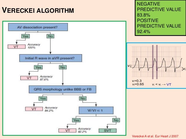 Wide complex tacycardia