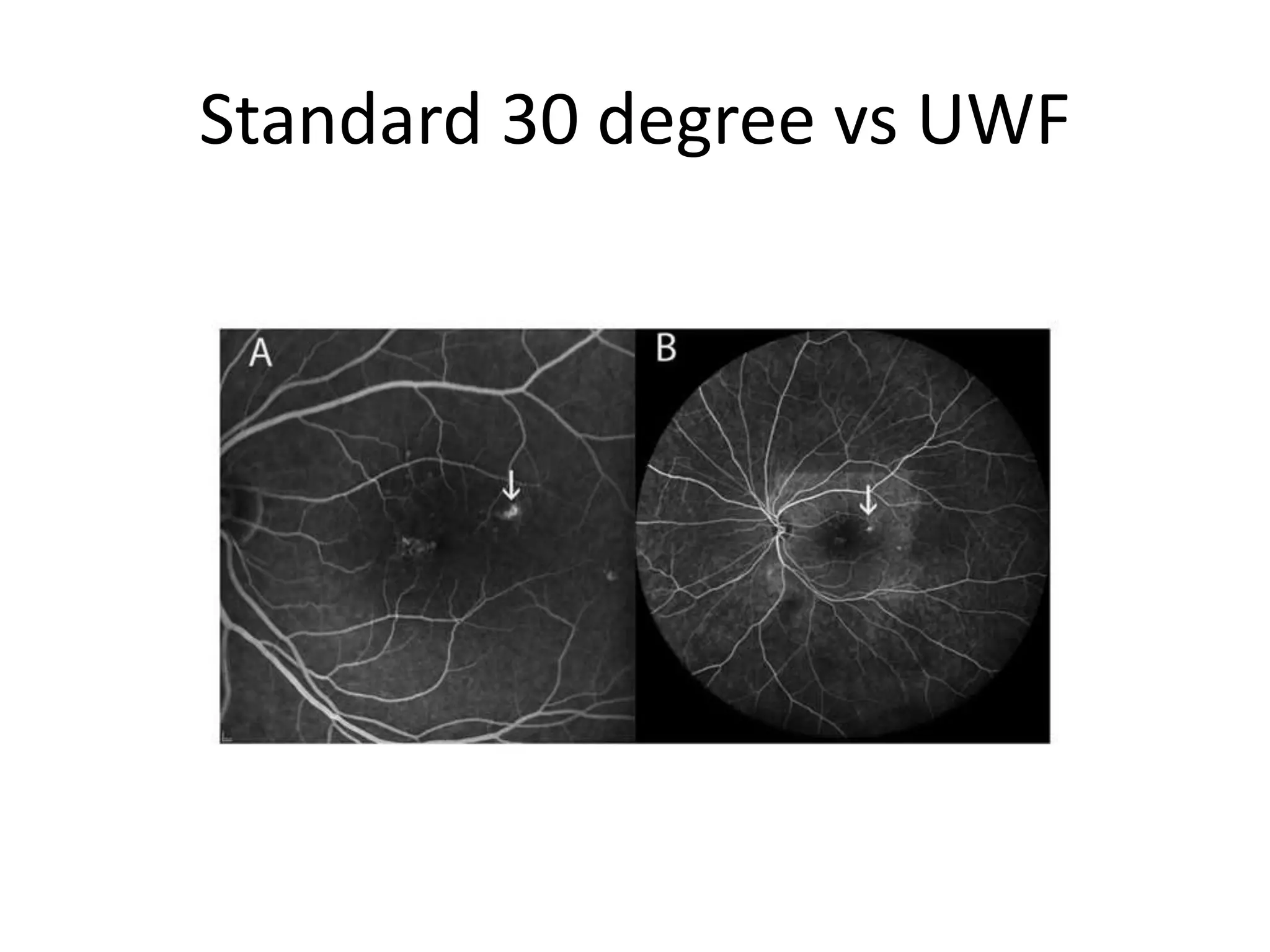 Wide field imaging in retinal pathology.pptx