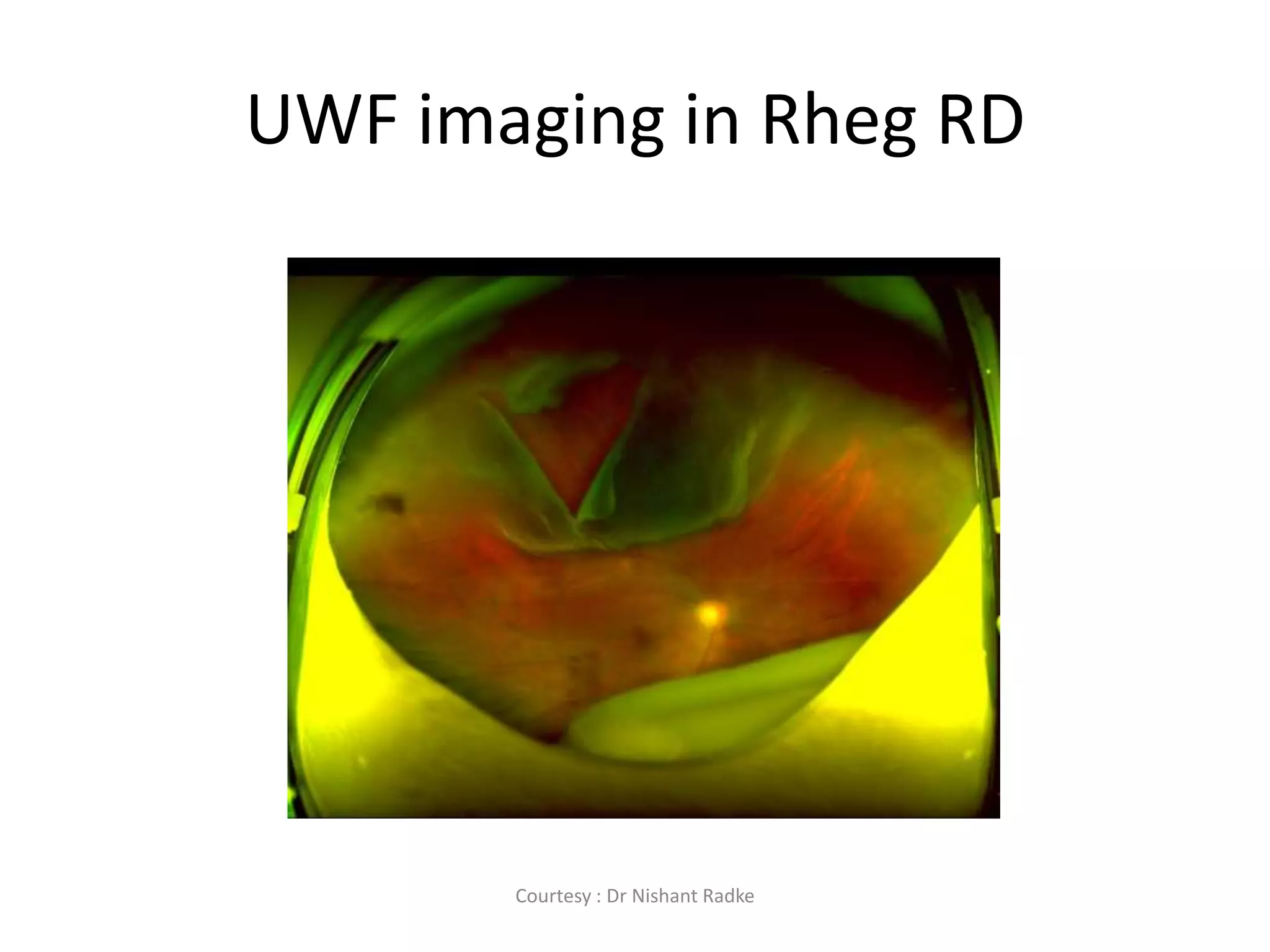 Wide field imaging in retinal pathology.pptx