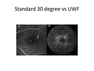 Wide field imaging in retinal pathology.pptx