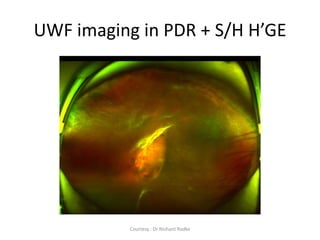 Wide field imaging in retinal pathology.pptx