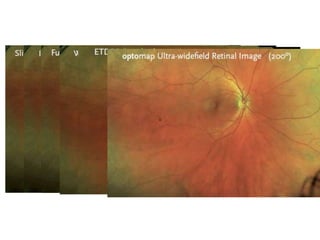 Wide field imaging in retinal pathology.pptx