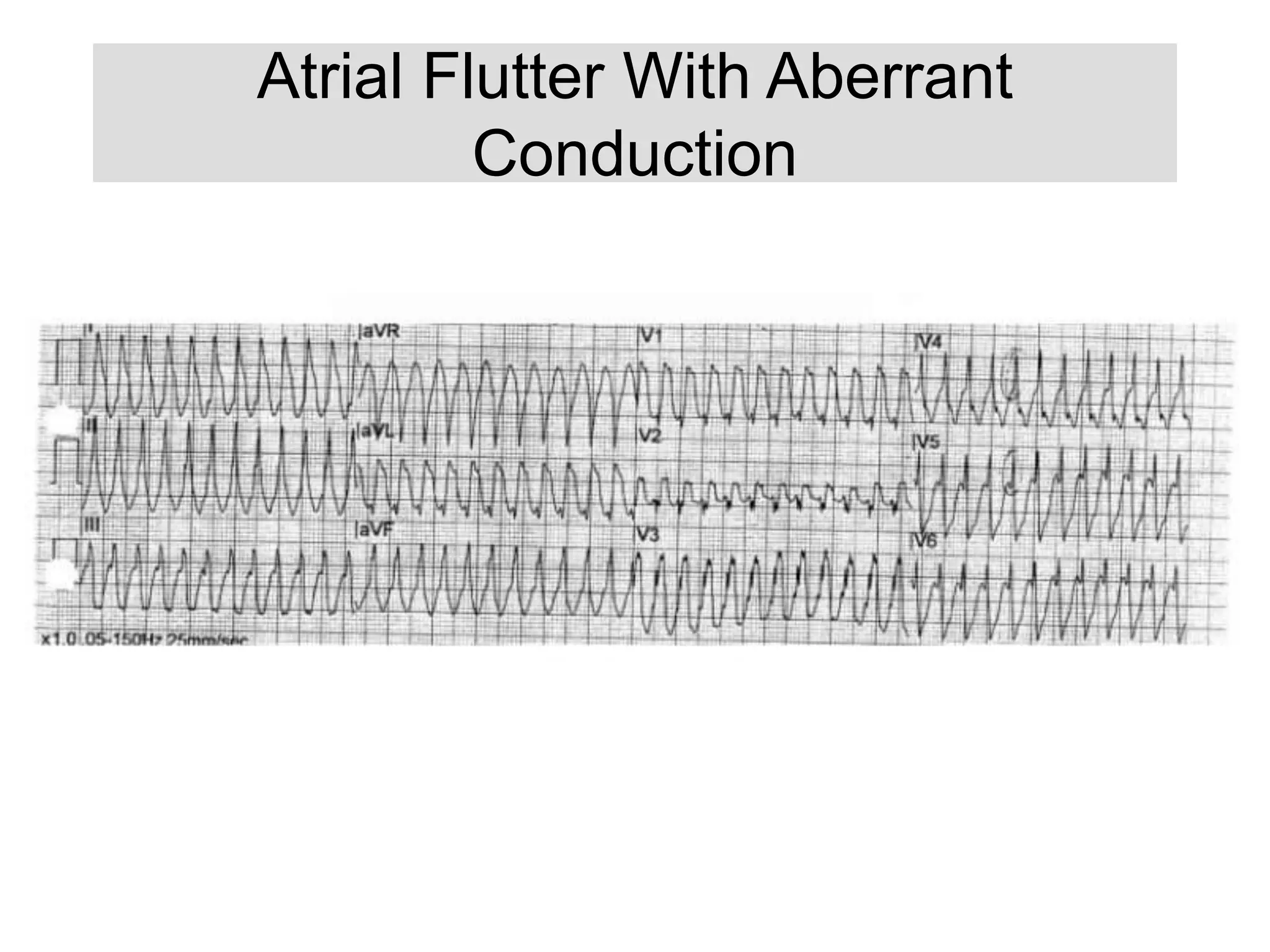 Irregular wide qrs tachycardia | PPT