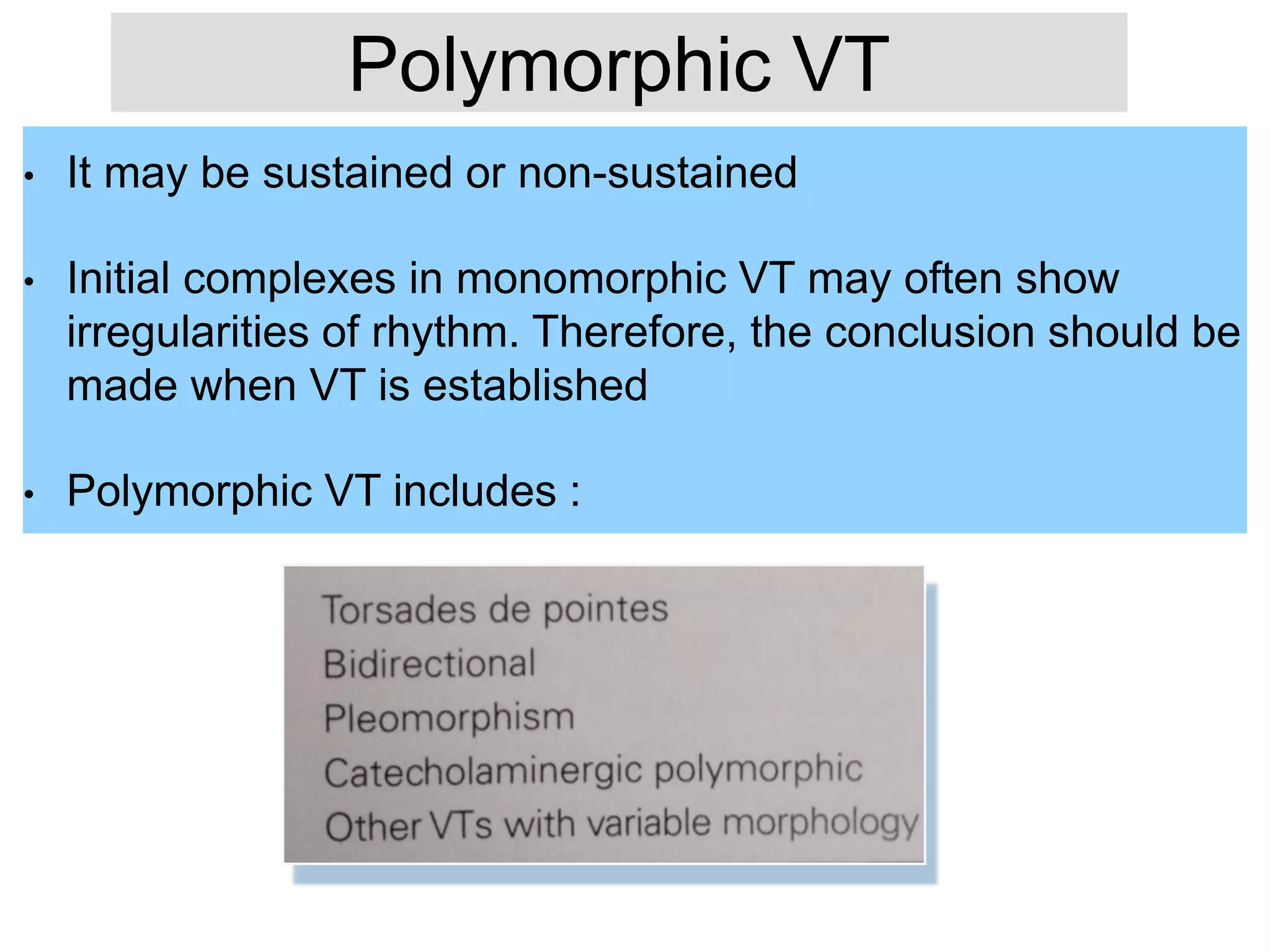 Irregular wide qrs tachycardia | PPT