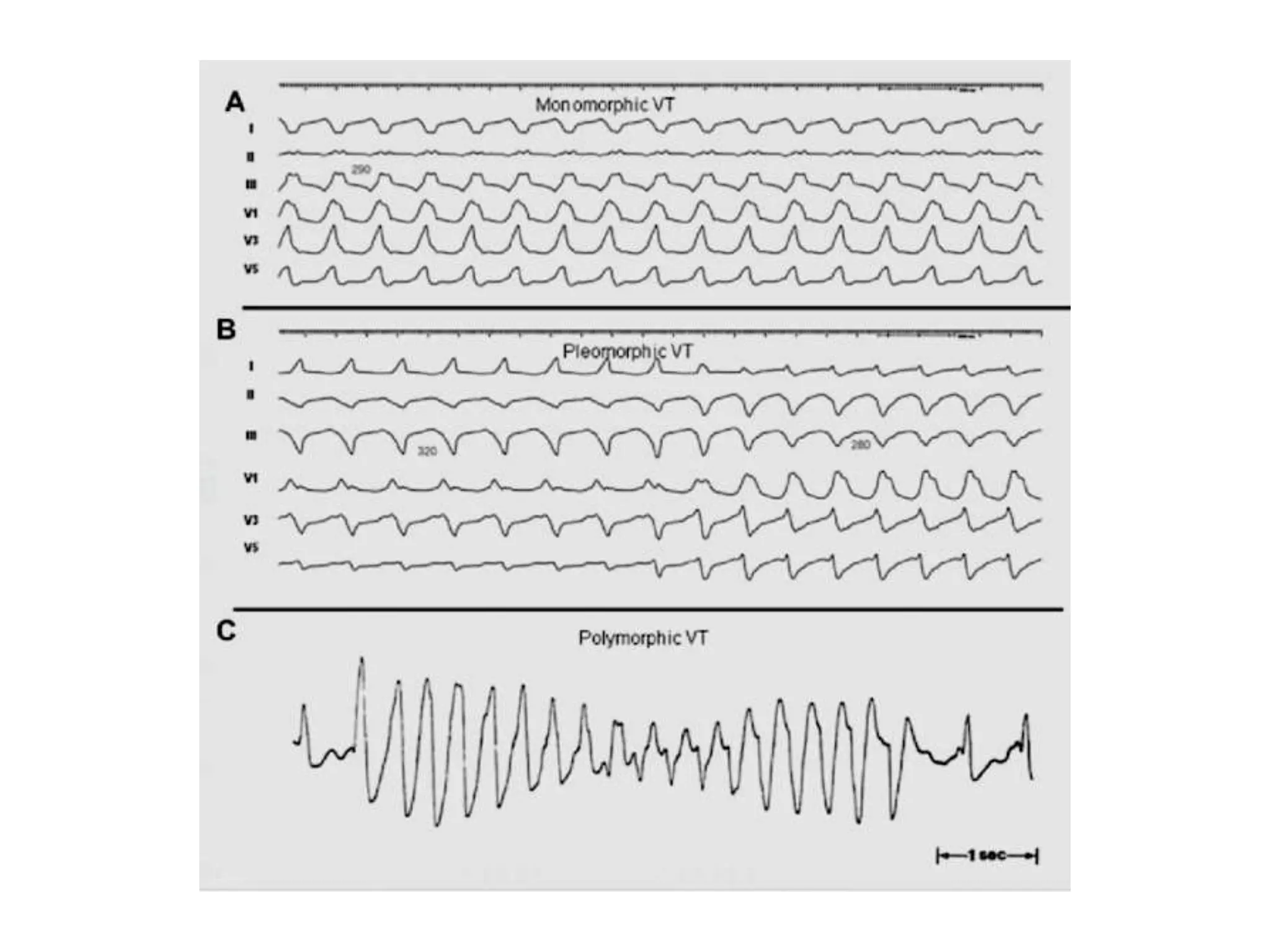 Irregular wide qrs tachycardia | PPT