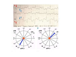 Irregular wide qrs tachycardia | PPT