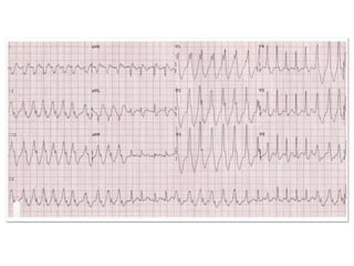 Irregular wide qrs tachycardia | PPT