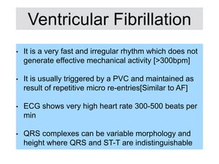 Irregular wide qrs tachycardia | PPT